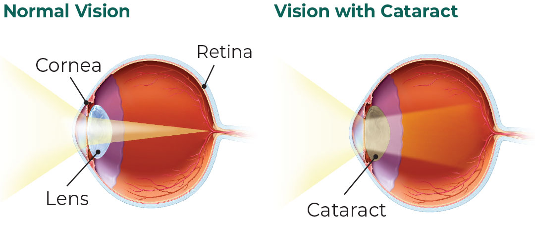 About Cataracts | Eye Guys